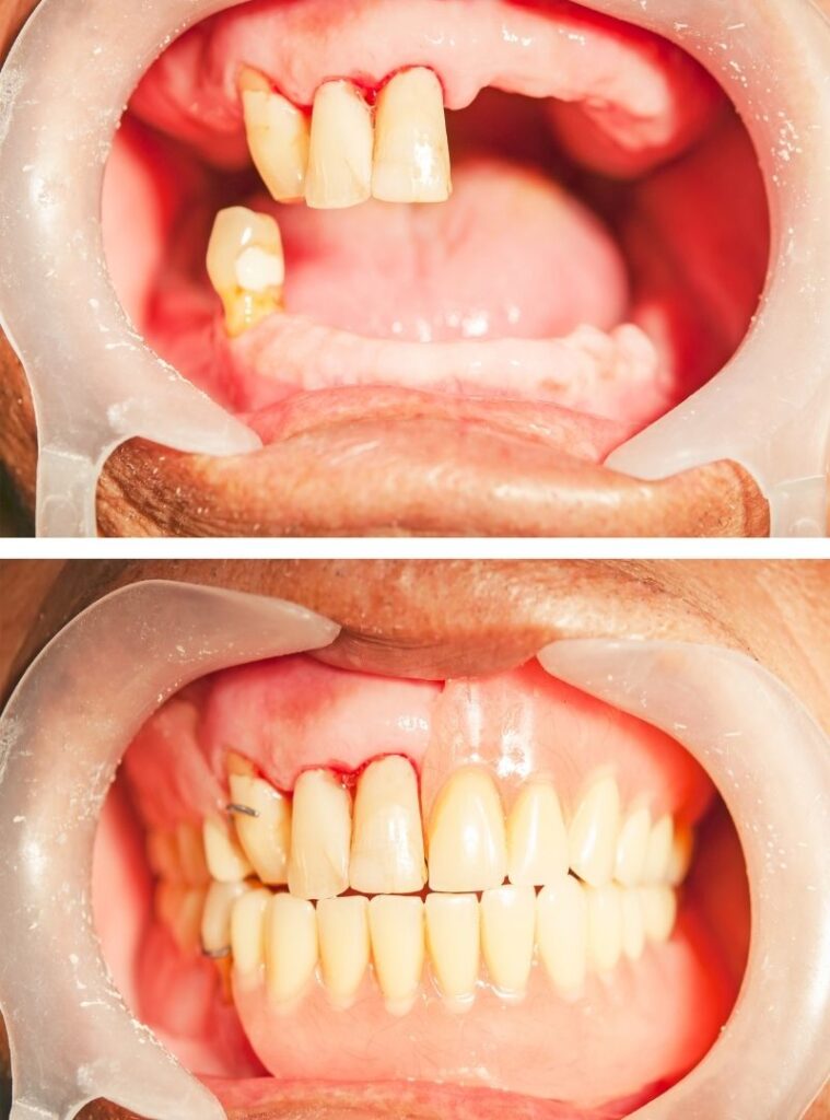 Full Mouth Reconstruction - Gables Perfect Smile