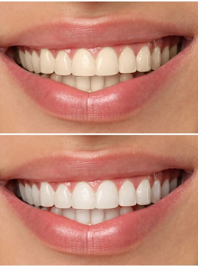 Smile Makeover — Miami and Coral Gables Area Practice